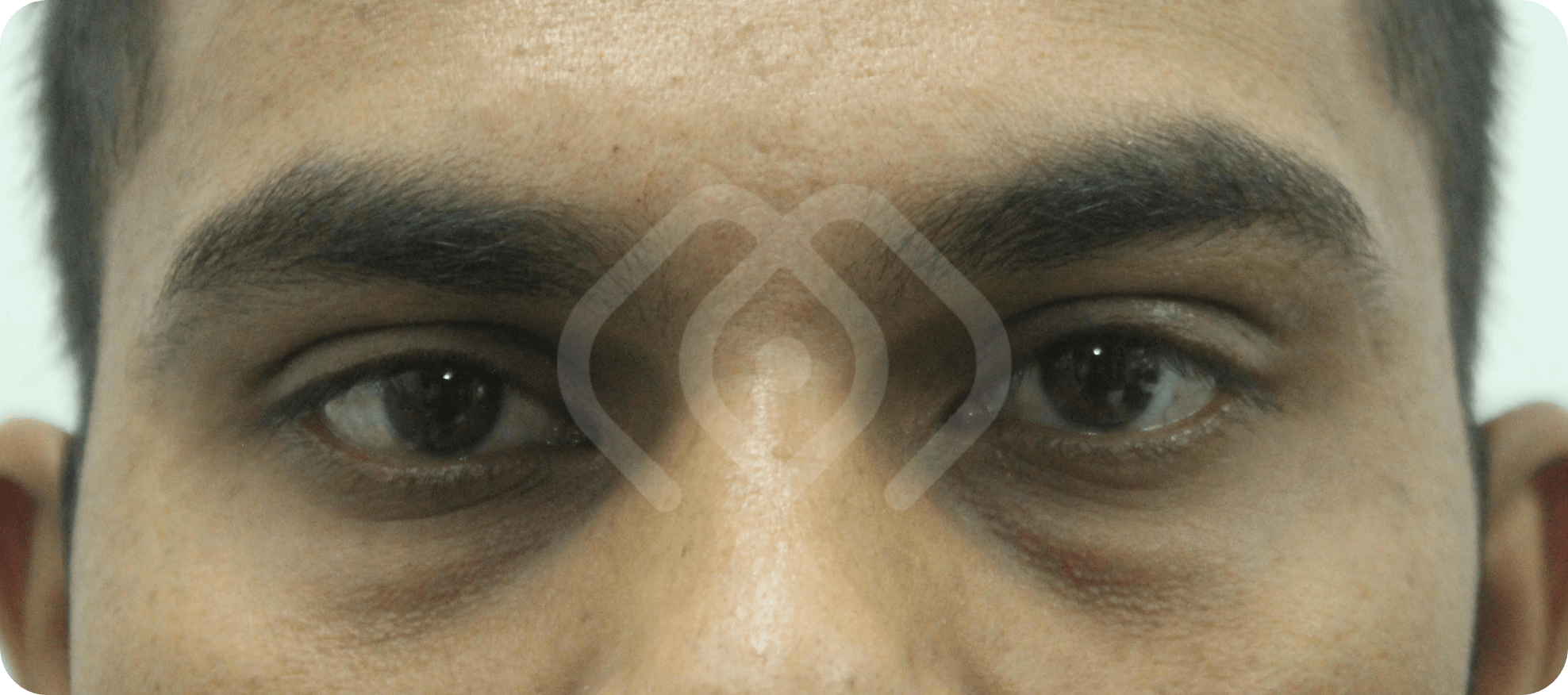 Ptosis Surgery in Mumbai | Droopy eyelid surgery | M.E.P.S